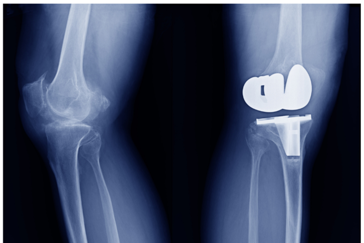 Joint replacement surgery